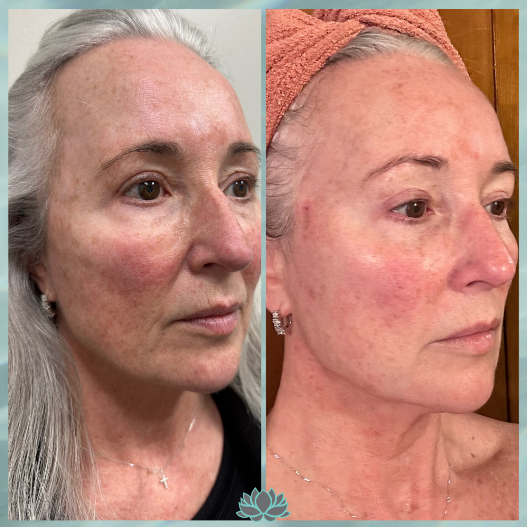 PDO Threads - The Skin Clinics